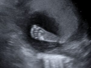 2D Pregnancy Ultrasound – Richelle Willemse Diagnostic Ultrasound