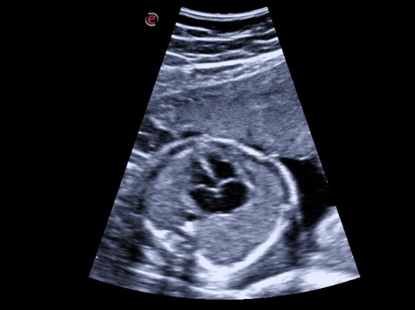 2D Pregnancy Ultrasound – Richelle Willemse Diagnostic Ultrasound